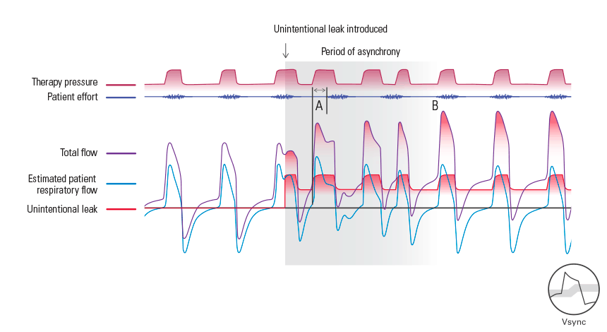 ResMed’s non-invasive ventilators suitable for COPD